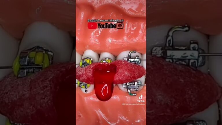 ¿Se Puede Comer Chicle con Brackets? Todo lo que Necesitas Saber - Tu ...